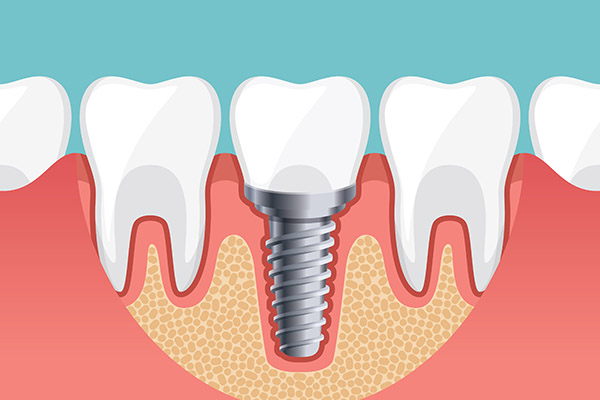 Understanding How Dental Implants Work